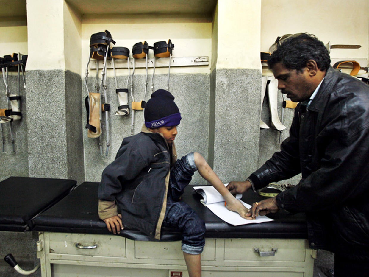 Poliomyelitis: 24 photos of crippling disease - Photo 1 - CBS News