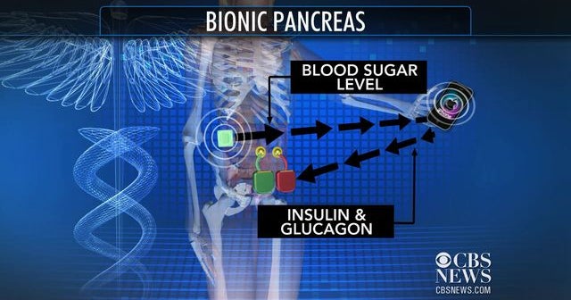 "Bionic" Pancreas helps manage type 1 diabetes - CBS News