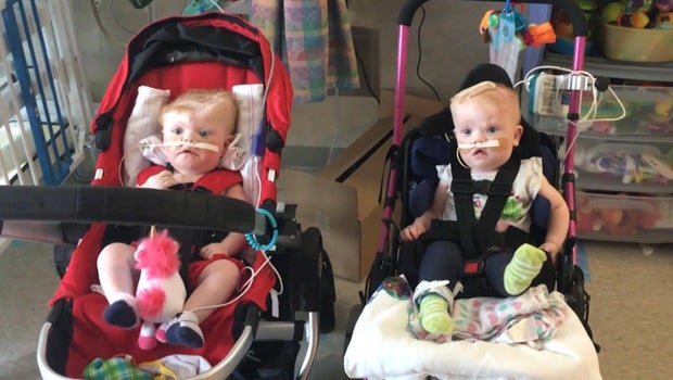 Recently separated conjoined twins getting ready to go home - CBS News